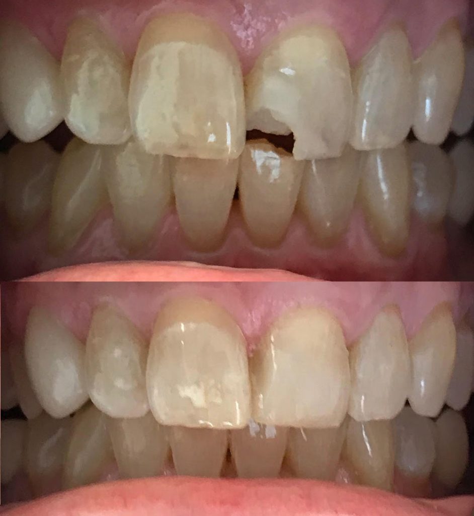 Smile Gallery|Carroll Dental Care