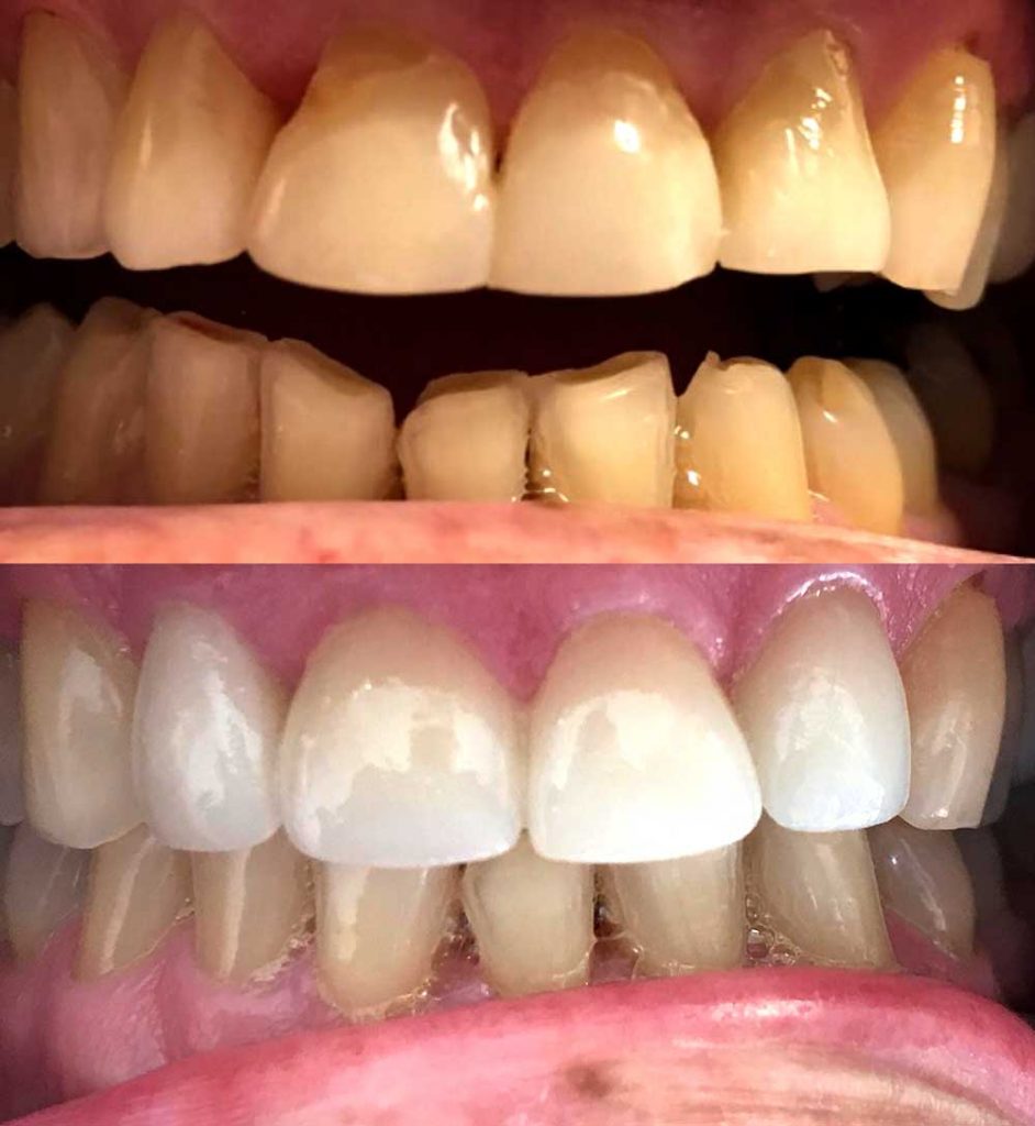 Smile Gallery|Carroll Dental Care